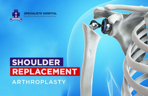 Shoulder Replacement Guide | Orthopedic Hospital in Ernakulam